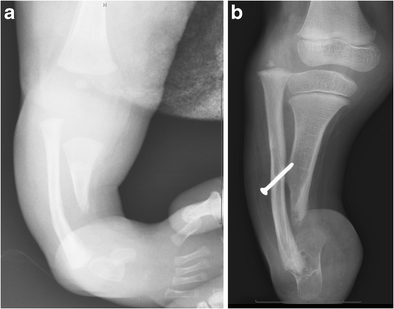 Systematic radiographic evaluation of tibial hemimelia with orthopedic ...
