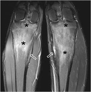 Multifocal bone and bone marrow lesions in children — MRI findings ...