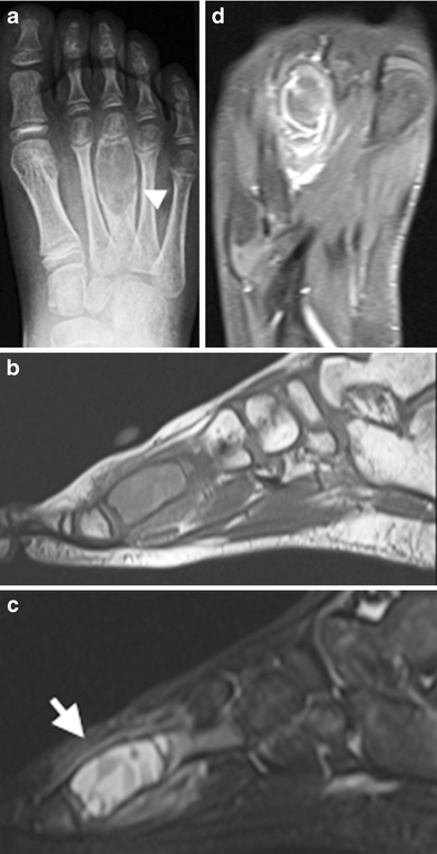 Bone tumors of the pediatric foot: imaging appearances | SpringerLink