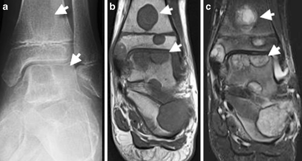 Bone tumors of the pediatric foot: imaging appearances | SpringerLink