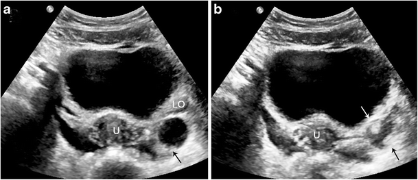 Emergent ultrasound evaluation of the pediatric female pelvis ...