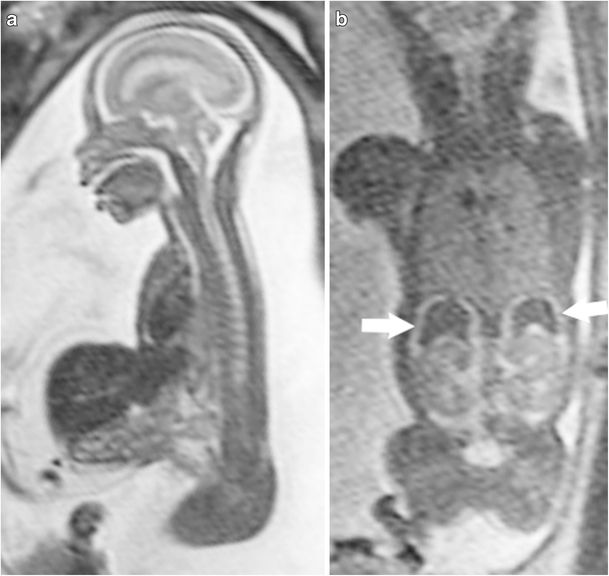 Fetal Anterior Abdominal Wall Defects Prenatal Imaging By Magnetic