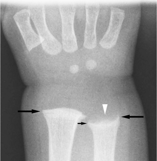 Distinguishing child abuse fractures from rickets | SpringerLink