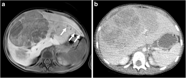 2017 PRETEXT: radiologic staging system for primary hepatic ...