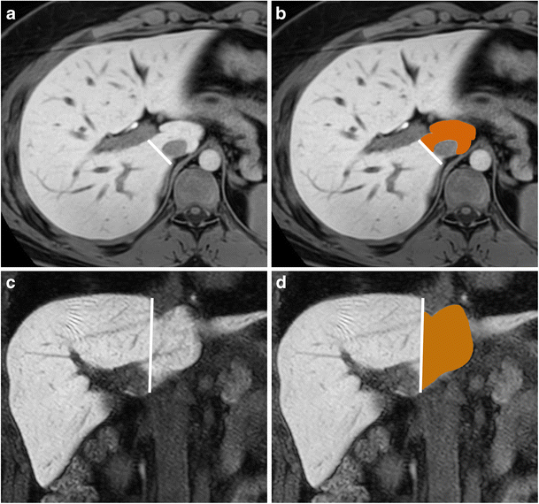 2017 PRETEXT: radiologic staging system for primary hepatic ...