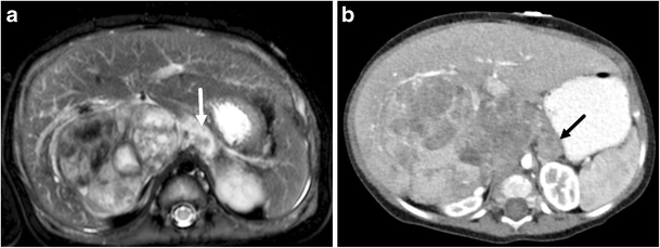 2017 PRETEXT: radiologic staging system for primary hepatic ...