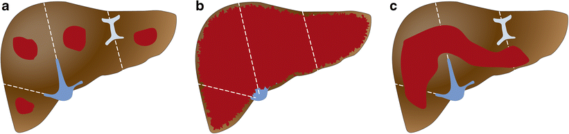 2017 PRETEXT: radiologic staging system for primary hepatic ...
