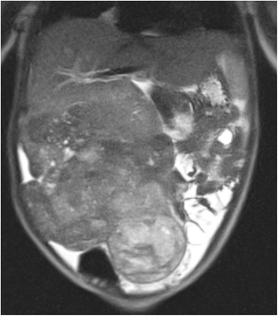 2017 PRETEXT: radiologic staging system for primary hepatic ...