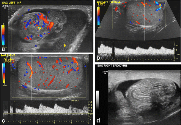 Testicular Torsion With Preserved Flow Key Sonographic Features And