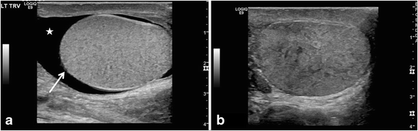 Testicular torsion with preserved flow: key sonographic features and ...