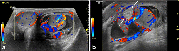 Testicular Torsion With Preserved Flow Key Sonographic Features And