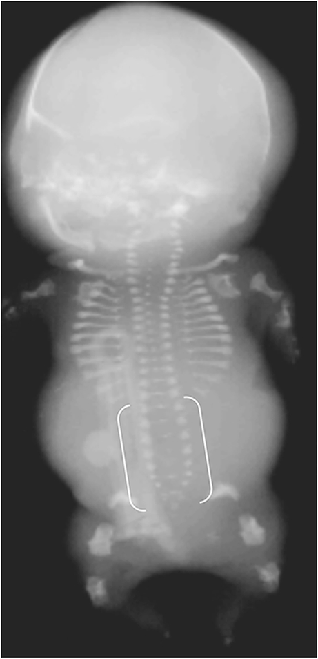 Differential diagnosis of perinatal hypophosphatasia: radiologic ...