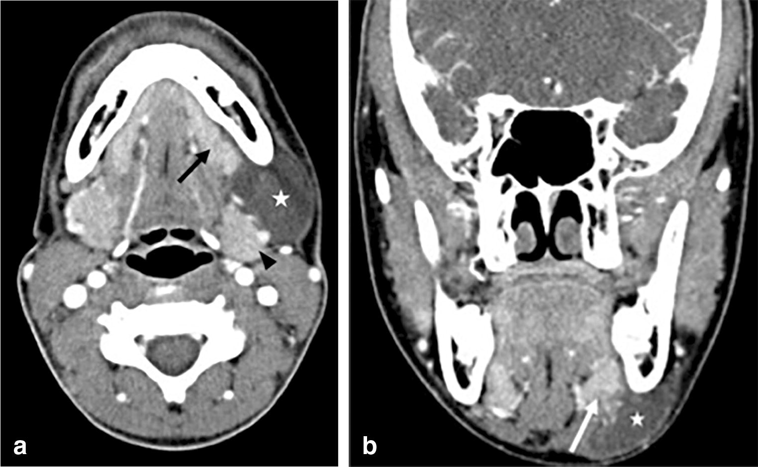 Percutaneous treatment of ranulas: ultrasound-guided drainage with ...