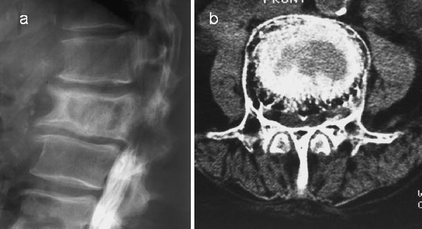 The spine in Paget’s disease | SpringerLink