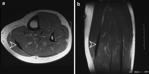Magnetic resonance imaging findings of injuries to the calf muscle ...