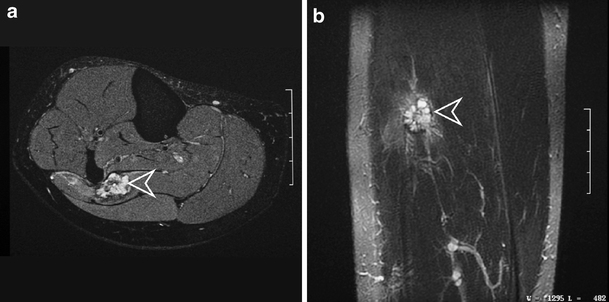 Magnetic resonance imaging findings of injuries to the calf muscle ...