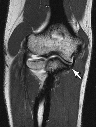 MR imaging of the elbow in baseball pitchers | SpringerLink