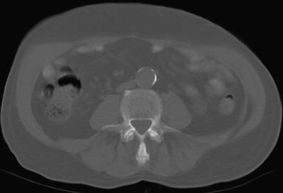 Baastrup’s disease (kissing spine) demonstrated by FDG PET/CT ...