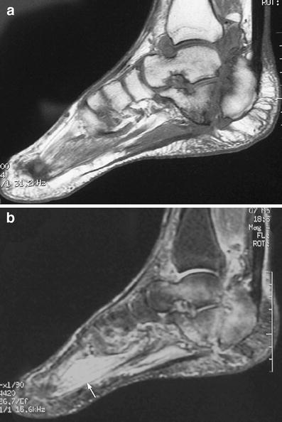 MRI appearance of muscle denervation | SpringerLink