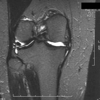Bone marrow edema in the knee in osteoarthrosis and association with ...