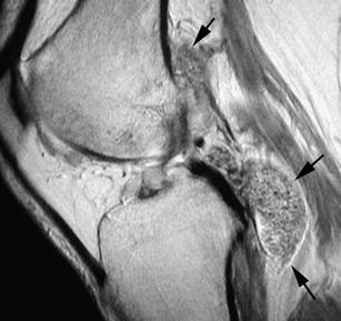 Synovial recesses of the knee: MR imaging review of anatomical and ...