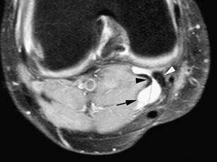 Synovial recesses of the knee: MR imaging review of anatomical and ...
