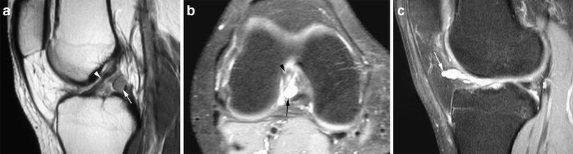 Synovial recesses of the knee: MR imaging review of anatomical and ...
