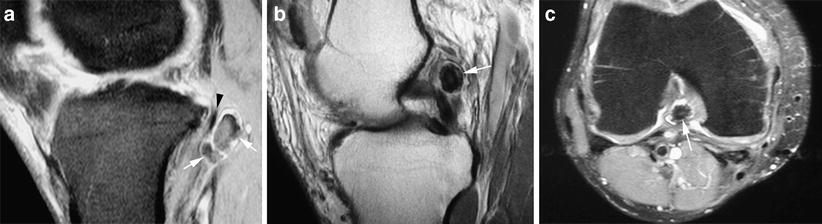 Synovial recesses of the knee: MR imaging review of anatomical and ...