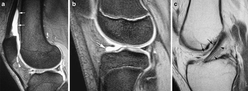 Synovial recesses of the knee: MR imaging review of anatomical and ...