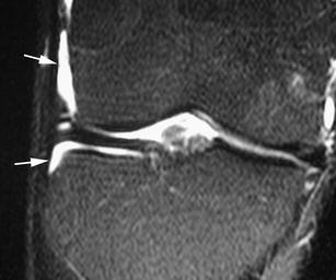 Synovial recesses of the knee: MR imaging review of anatomical and ...