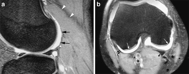 Synovial recesses of the knee: MR imaging review of anatomical and ...