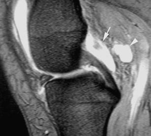 Synovial recesses of the knee: MR imaging review of anatomical and ...