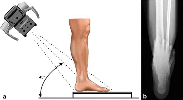 Measuring hindfoot alignment radiographically: the long axial view is ...