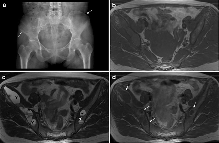 Emphasis on the MR imaging findings of brown tumor: a report of five ...