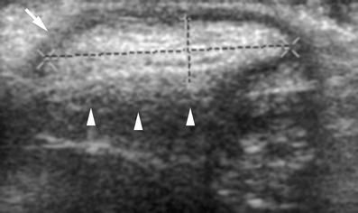 Ultrasound features of tophi in chronic tophaceous gout | SpringerLink