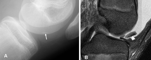 The “sliver sign”: a specific radiographic sign of acute lateral ...