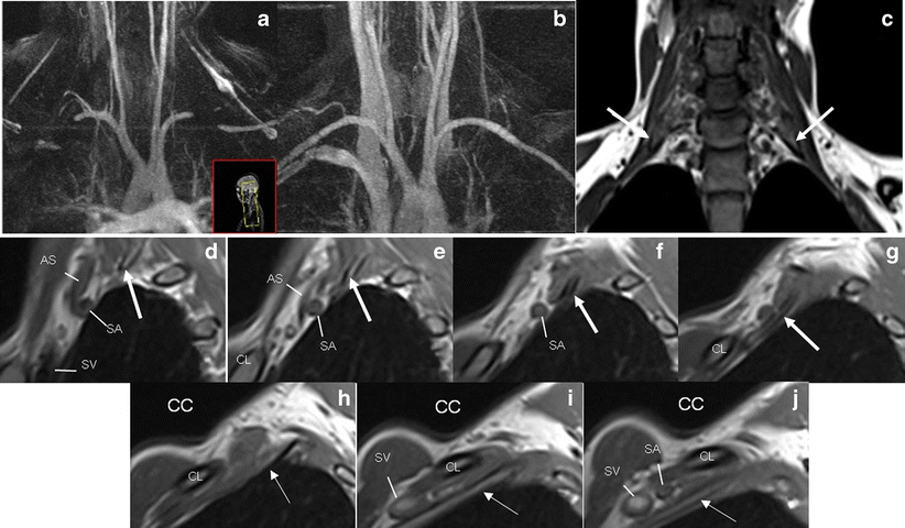 MRI findings in thoracic outlet syndrome | SpringerLink