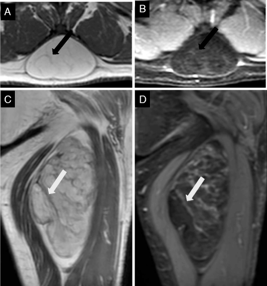 MRI characteristics of lipoma and atypical lipomatous tumor/well ...