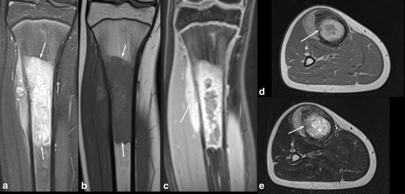 Ewing sarcoma versus osteomyelitis: differential diagnosis with ...
