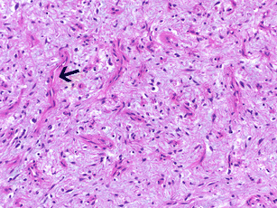 Soft tissue angiofibroma: a case report | SpringerLink