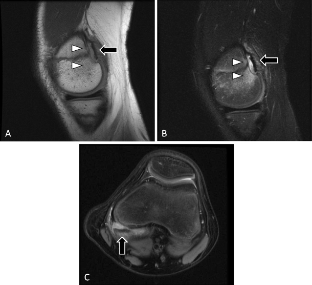 Isolated avulsion fracture at the medial head of the gastrocnemius ...