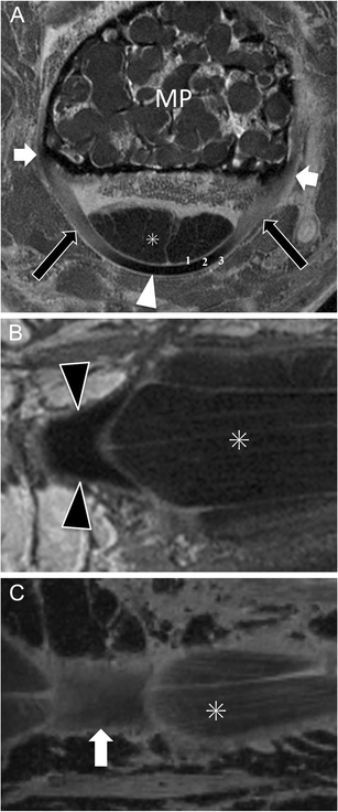Magnetic resonance imaging of the pulleys of the flexor tendons of the ...