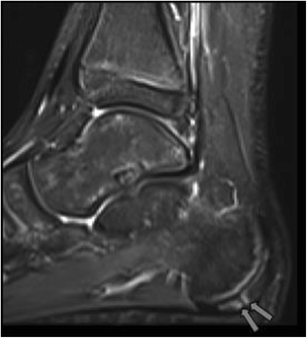 Normal skeletal development and imaging pitfalls of the calcaneal ...