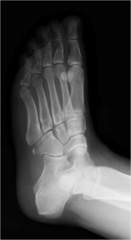 Painful lateral foot swelling | SpringerLink
