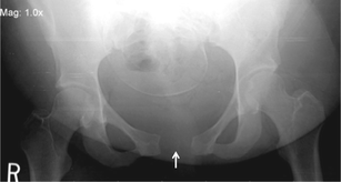 Parturition pit: the bony imprint of vaginal birth | SpringerLink