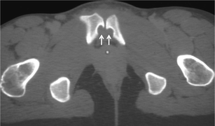 Parturition pit: the bony imprint of vaginal birth | SpringerLink