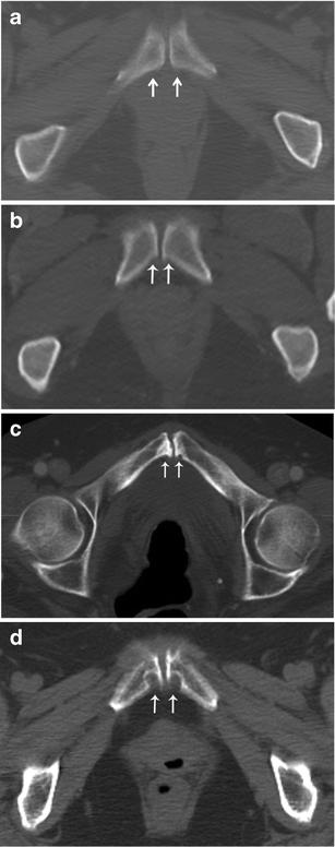 Parturition pit: the bony imprint of vaginal birth | SpringerLink