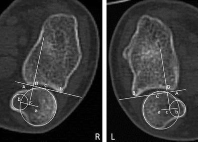 Computed tomography for the detection of distal radioulnar joint ...