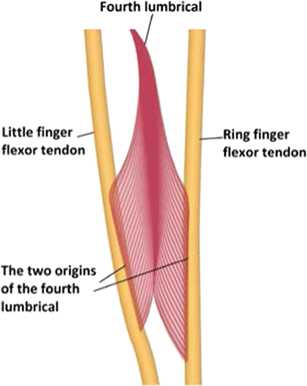 Ring finger lumbrical origin strain: a case series with imaging ...