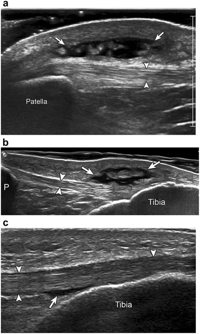 Ultrasound evaluation of bursae: anatomy and pathological appearances ...